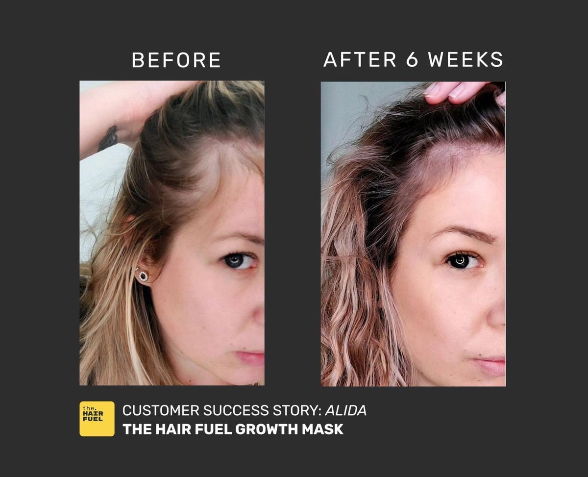 Hair growth success story: Alida – The Hair Fuel